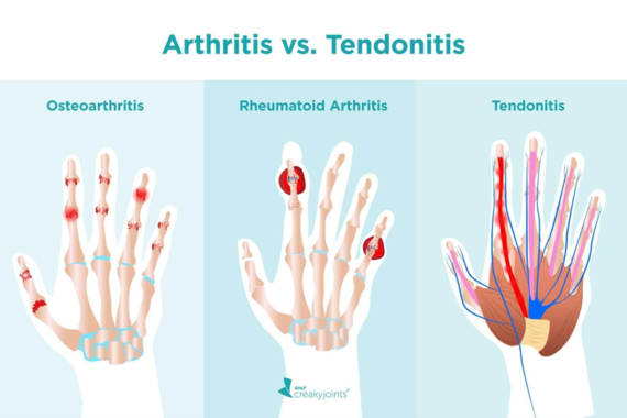 Hand Arthritis Conditions: Causes & Symptoms | Sforzo Dillingham