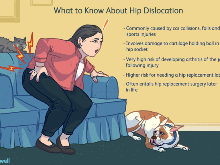 Expert Treatment for Hip Dislocation | Sforzo Dillingham