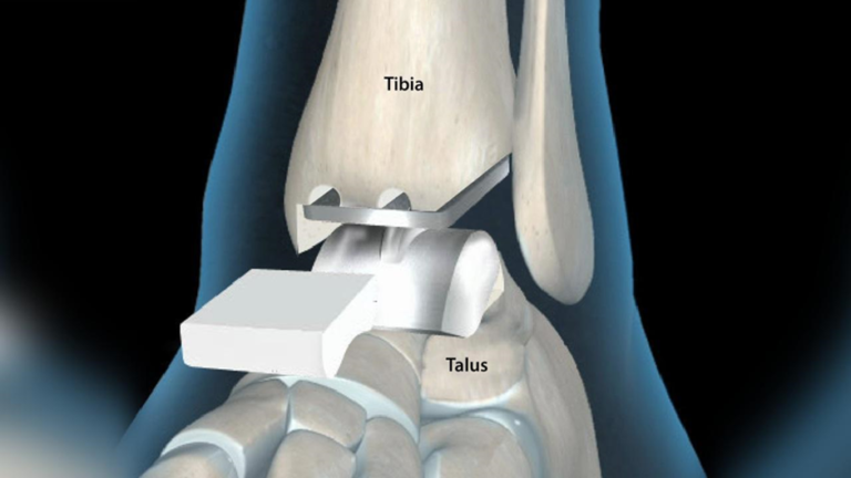 Advanced Solution of Total Ankle Replacement | Sforzo Dillingham